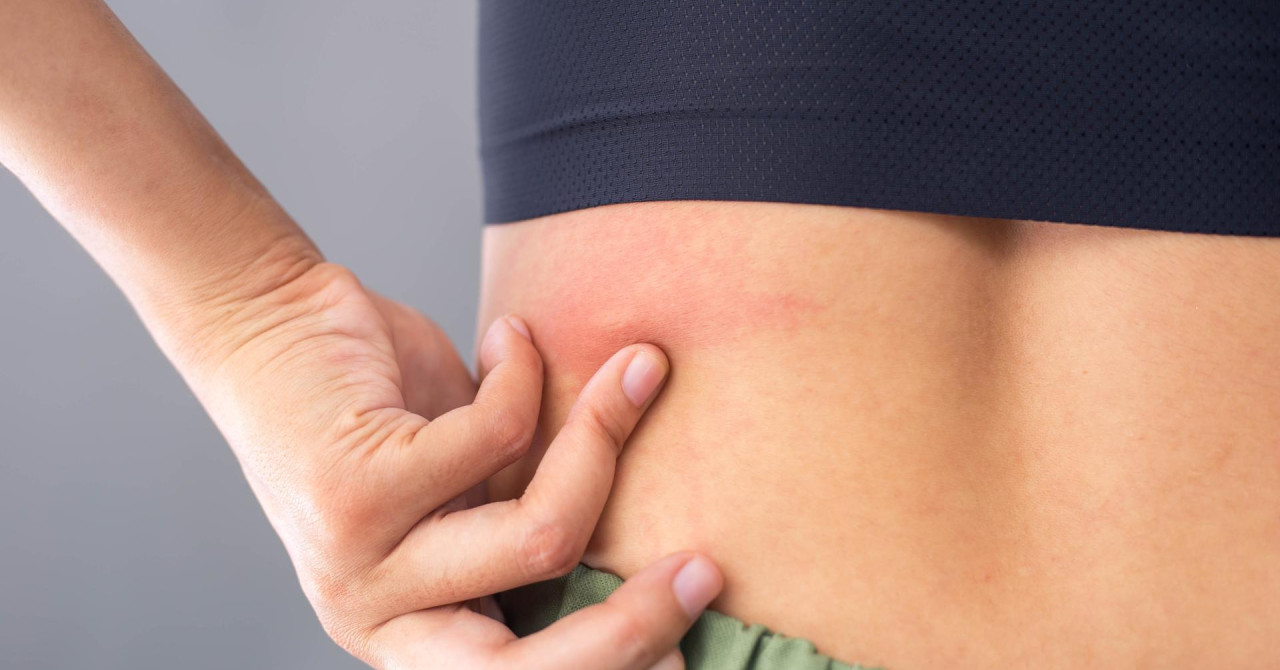 Živim - Ubodi komaraca, osa i stršljena: kada je bezopasno, a kada ...